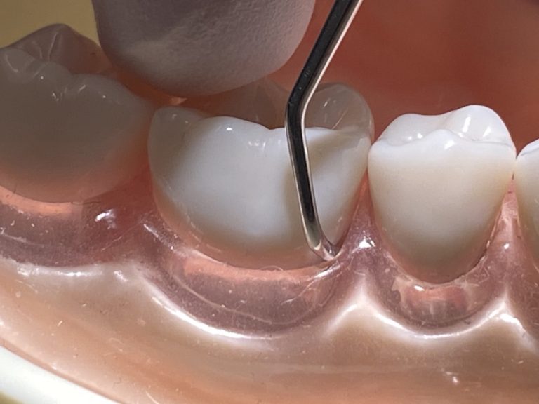 歯科専門用語のSRPとSCって何？どう違うの？教えて歯科衛生士さん！ | 平澤歯科